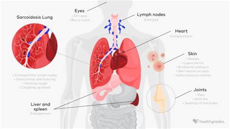 Sarcoidosis Symptoms Causes And Treatments