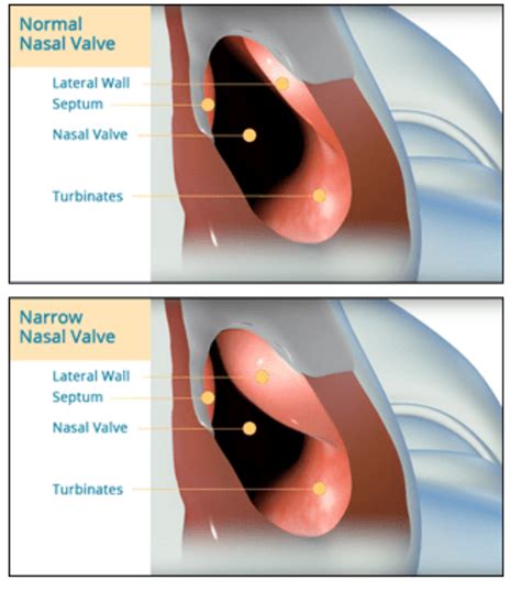 Nasal Breathing Relief In Los Angeles Sinus Breathing Relief