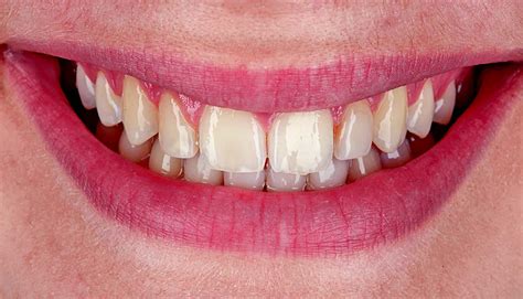 Flowable Composite Resins Esthetics At Your Fingertips Quintessence Publishing Blog