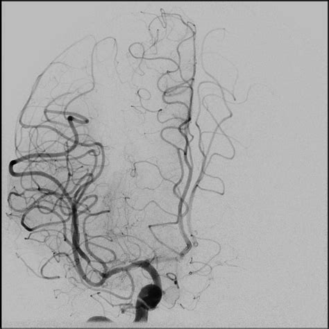 Fileproximal Right Mca M1 Segment Embolic Occlusion Radiopaedia 56974