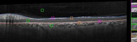 Example Oct Scan Left From Dataset 2 Showing Samples From The