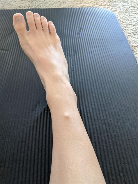 How To Treat A Hematoma Hard Lump Under Skin Or Leg T