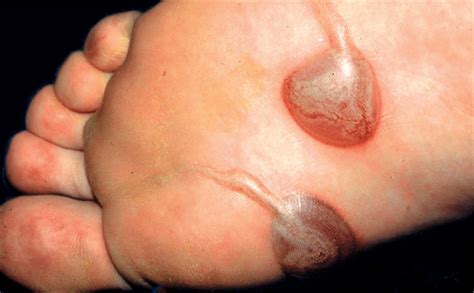 Hookworm Disease