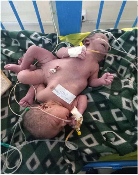 Figure 1 From A Case Of Ischiopagus Dicephalus Conjoined Twins With Tetrabrachius Bipus From