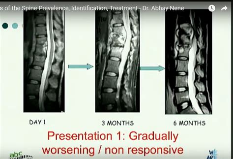 Drug Resistant Tuberculosis Of Spine —