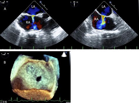 Two Dimensional Transesophageal Echocardiography Tee Showed A Single