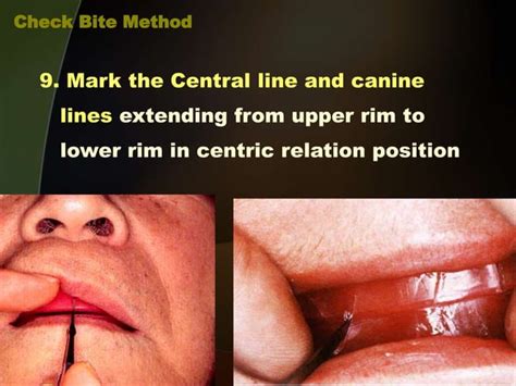 Clinical Steps For Complete Denture Construction 4 Steps Of Recording Jaw Relation E Centric