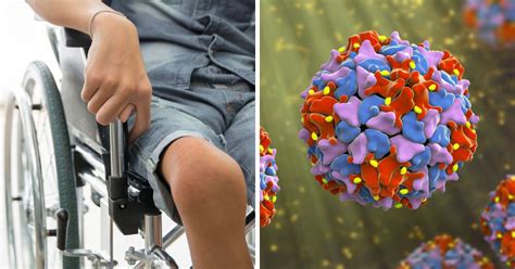 ¿qué Es La Poliomielitis Se Puede Prevenir Salud180