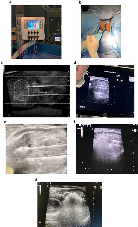 illustration of the laser ablation procedure a power setting of each