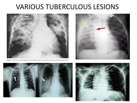 Cxr Interpretation In Tb Patients Ppt Free Download