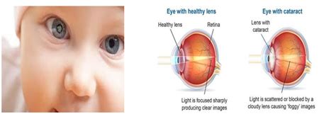 What Does Lazy Eye Mean Best Optometrist Dr Jeff Sciberras