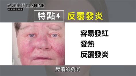 酒糟肌難分辨皮膚專科王朝輝醫師分享4大特徵教你分辨 YouTube