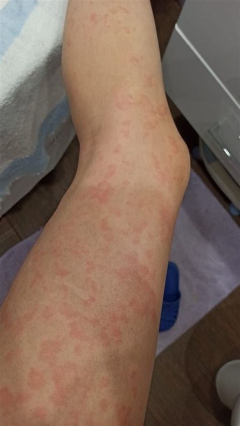 These Pictures Will Help You Id The Most Common Bug Bites And Their