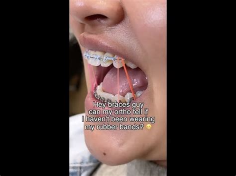 Are You Supposed To Sleep With Rubber Bands On Braces