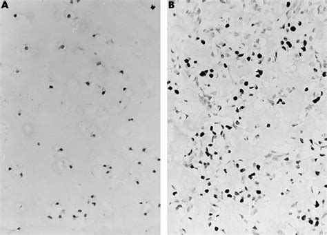 Intermediate Grade Osteosarcoma And Chondrosarcoma Arising In An