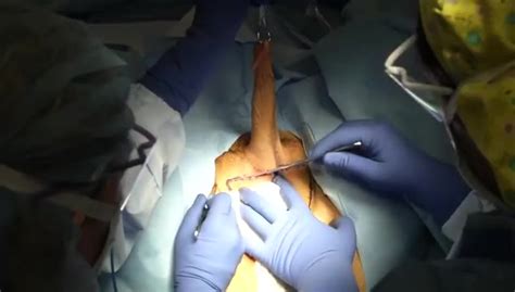 Male To Female Bye Bye Balls