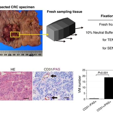 Vasculogenic Mimicry Vm Formation Defined By Cd31−pas Expression Is
