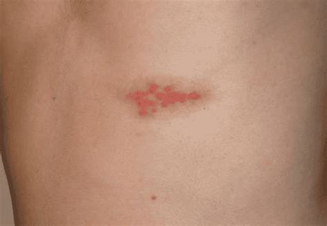 Shingles Get Treated For Free