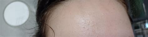 Bumps On Forehead Rdermatologyquestions