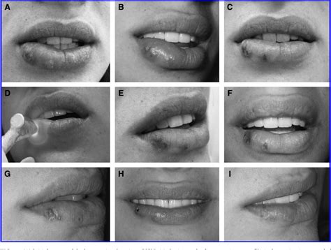 Low And High Intensity Lasers In The Treatment Of Herpes Simplex Virus