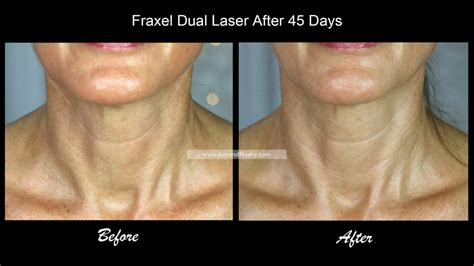 Fraxel Dual Laser Treatment For Sun Damage Chest Neck Before