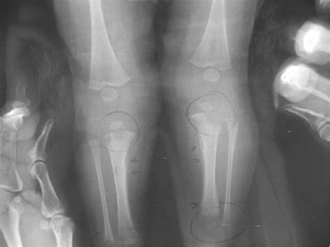 Osteolytic Lesions Of The Proximal Tibial Metaphysis Download Scientific Diagram