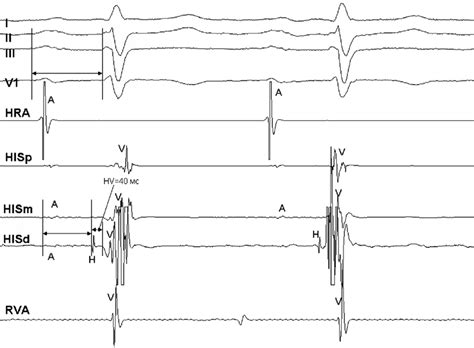 degree 1 av block proximal or suprahisian the leads i ii iii and