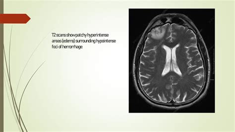 Cerebral Contusion Presentation Slide Share Pptx