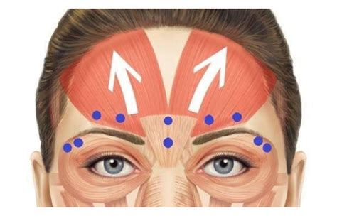 Detailed Information On Botox Eands Lounge Forehead Wrinkles Botox