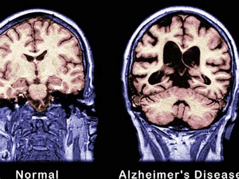 Is Too Much Of A Good Thing Behind Alzheimers Disease Scientists To