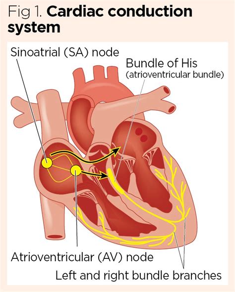 Pacemaker Therapy 1 Clinical Indications Placement And Complications