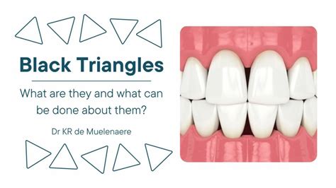 What To Do About Black Triangles Between Your Teeth Saso