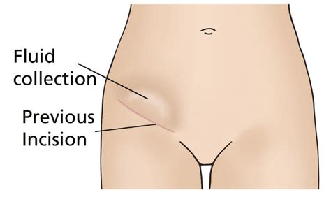 Vulval Surgery Leeds Teaching Hospitals Nhs Trust