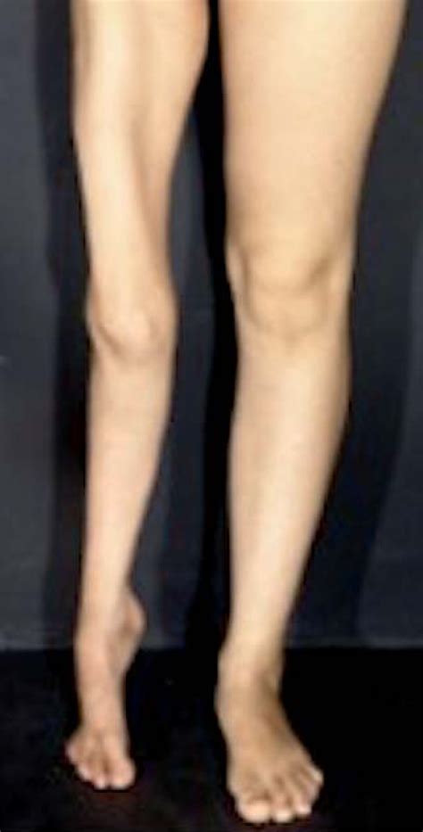 Linear Scleroderma Leg