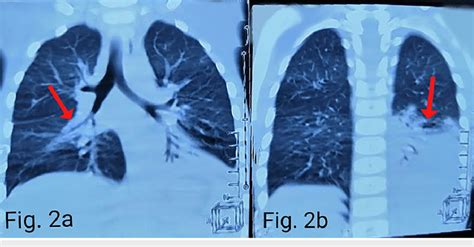 CT Scan Coronal View Of The Chest Showing Large Areas Of