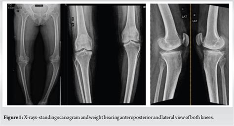 A Rare Complication Of Sequential Bilateral Posterior Knee Dislocation