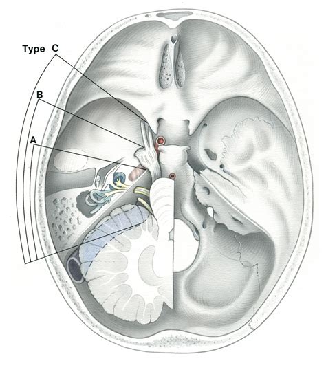 Infratemporal Fossa Approaches Skull Base Surgery Atlas