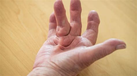 8 Surprising Dupuytrens Contracture Facts Causes And Treatment