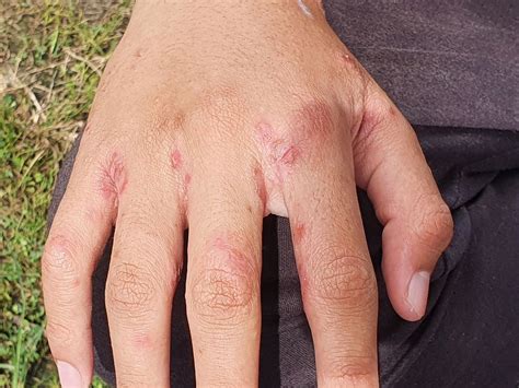Scabies Rash On Hands Scabies Diagnosis And Treatment With Images