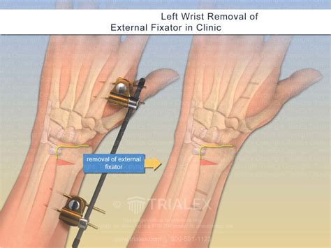 External Fixation