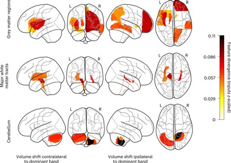 Right Handedness Related Regional Asymmetries Show Rightward Shifts In Download Scientific