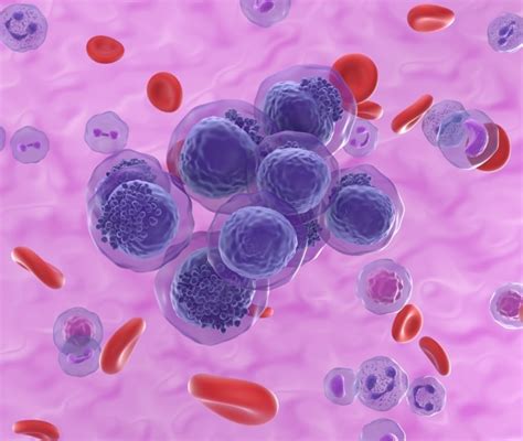 Patogenese Da Leucemia Linfocitica Cronica Leucemia EosinofÍlica