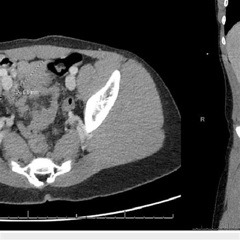 Ct Showing A 7 Mm Fluid Filled Appendix With A Mildly Enhancing Wall