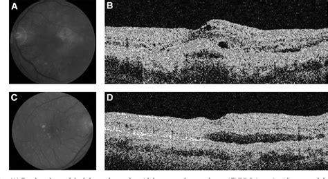 Figure 1 From Intravitreal Anti Vascular Endothelial Growth Factor Therapy For Choroidal