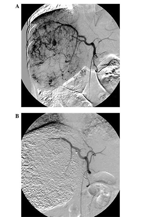 An Effective Approach For Treating Unresectable Hepatoblastoma In