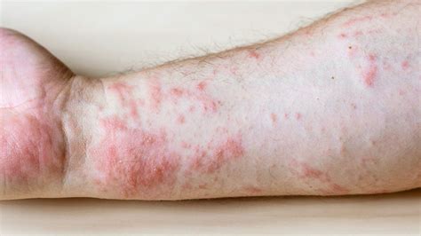 Red Bumps On Arms Not Itchy