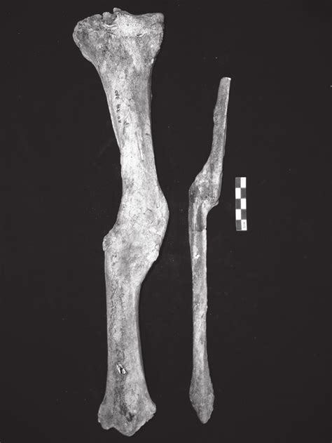 T102 Consolidated Displaced Fracture Of The Tibia Diaphysis And Right Download Scientific