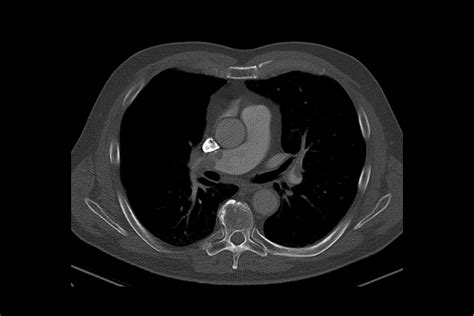 Rsna Ai Challenge 2020 Reviewing The Winning Algorithms Of The Pulmonary Embolism Detection