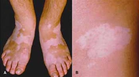 Generalized Vitiligo