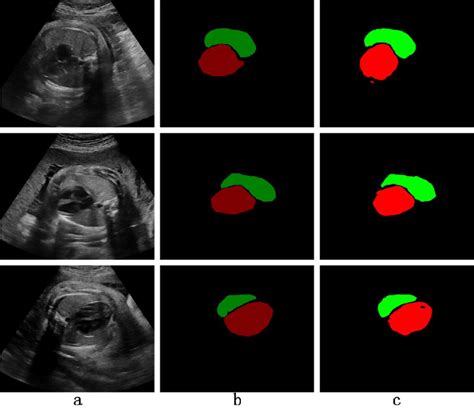 Fetal Lung Segmentation Results A The Fetal Lung Ultrasound Images B Download Scientific